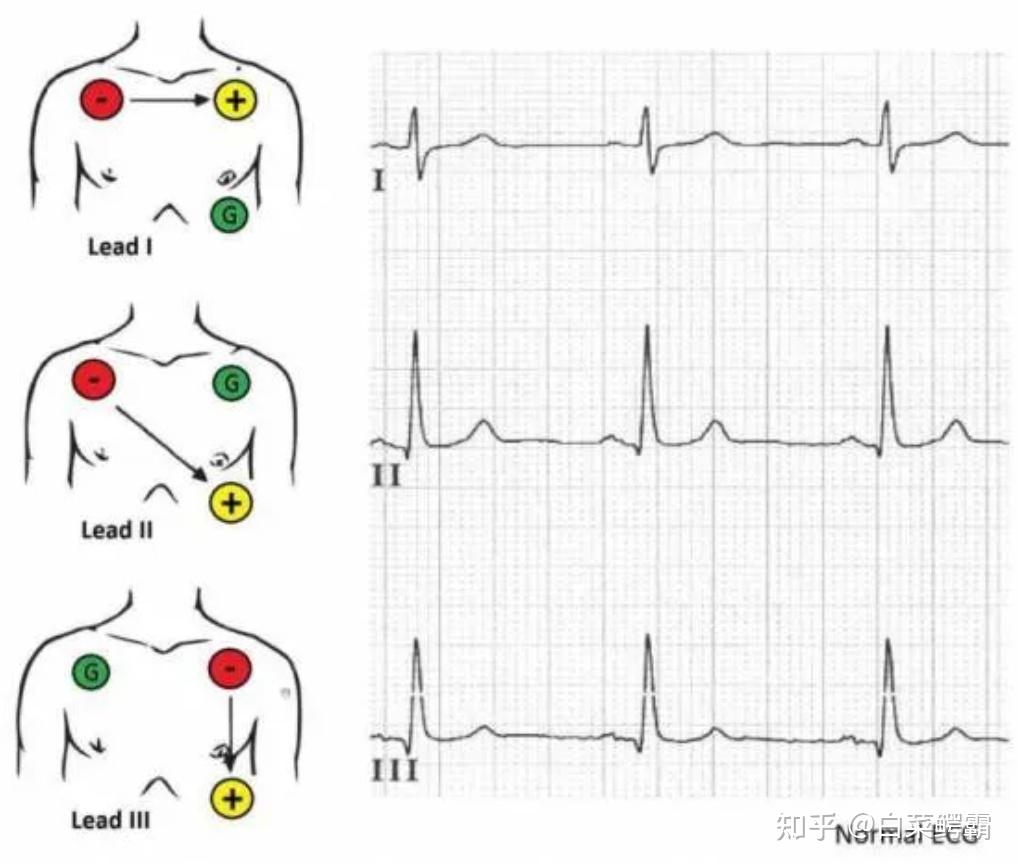 心血管系统｜心电图基础 ECG / Electrocardiography - 知乎