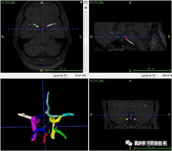 Top_Cow 2023——用于CTA和MRA的Willis环的拓扑解剖结构分割 - 知乎