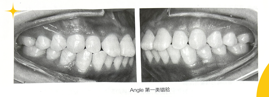 病例诊断｜错𬌗畸形的分类、检查与诊断 - 知乎