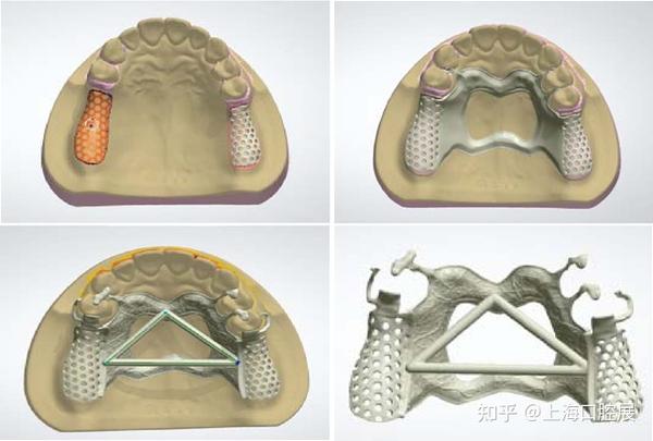 数字化技术在可摘局部义齿中的应用 - 知乎