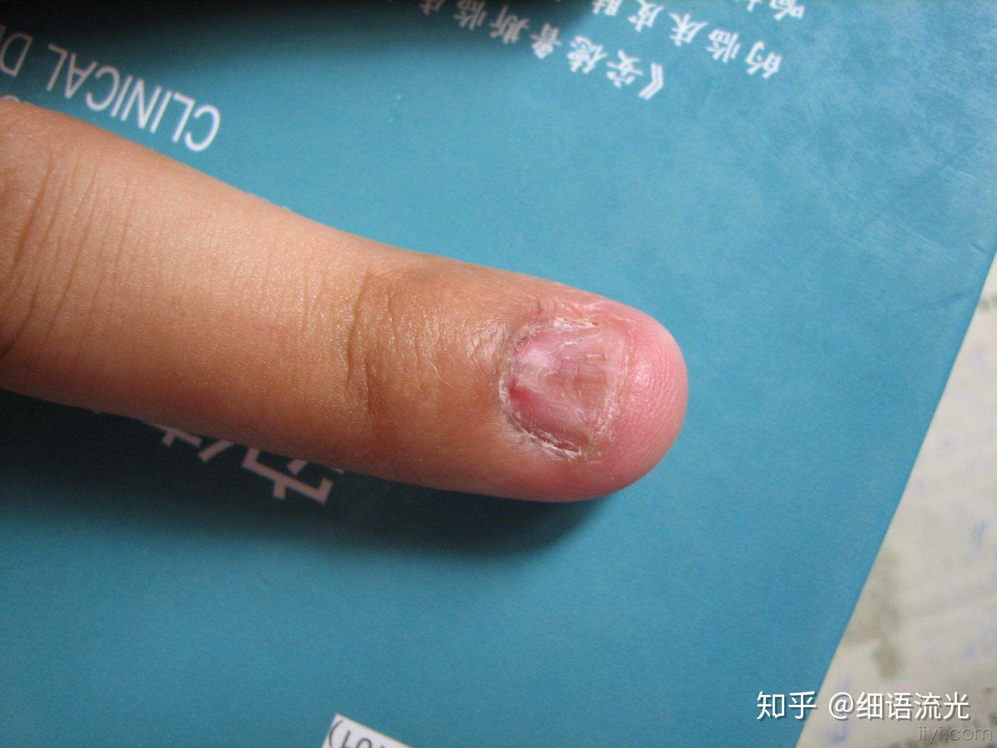 咬手指甲是一种怎样的习惯?有什么危害?怎样戒除? 知乎