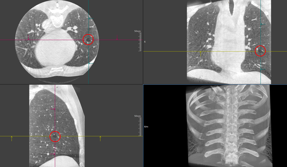 一影技术 ∣ 说说CBCT技术提升慢阻肺手术效率的事 - 知乎