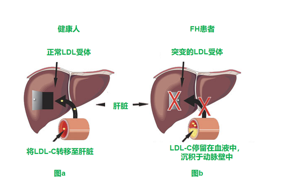家族性高胆固醇血症（FH）是如何遗传的？ - 知乎