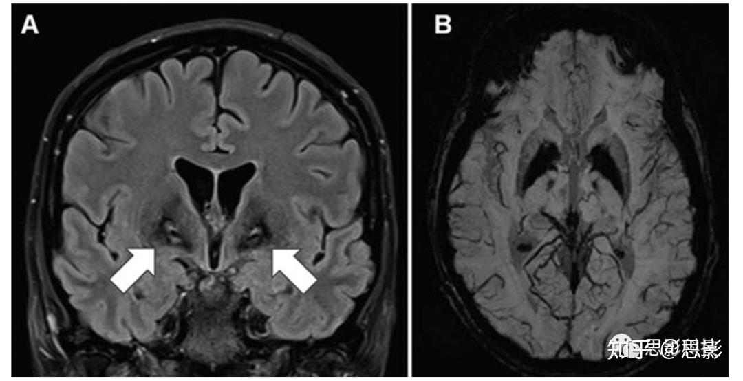 磁敏感加权成像（SWI)：技术要点和临床神经学应用 - 知乎