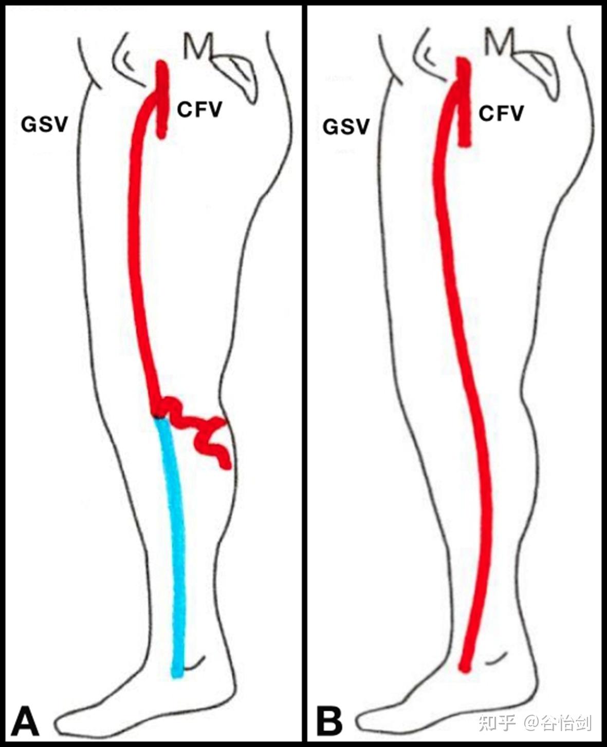 下肢静脉曲张和硬化剂治疗 - 知乎