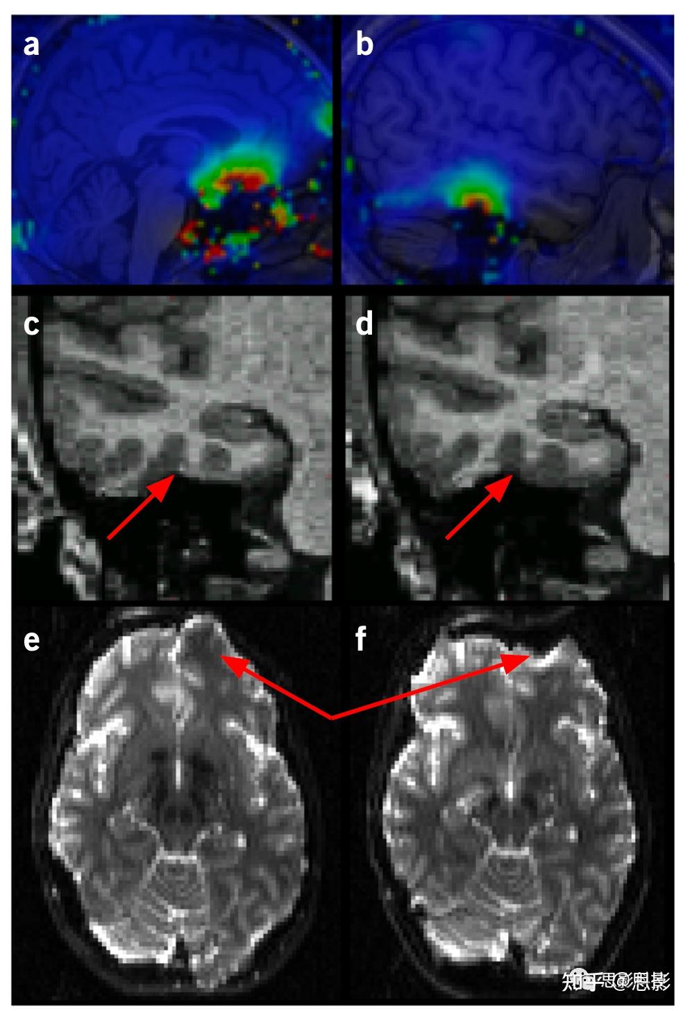 Nature Neuroscience：利用MRI研究神经解剖学 - 知乎