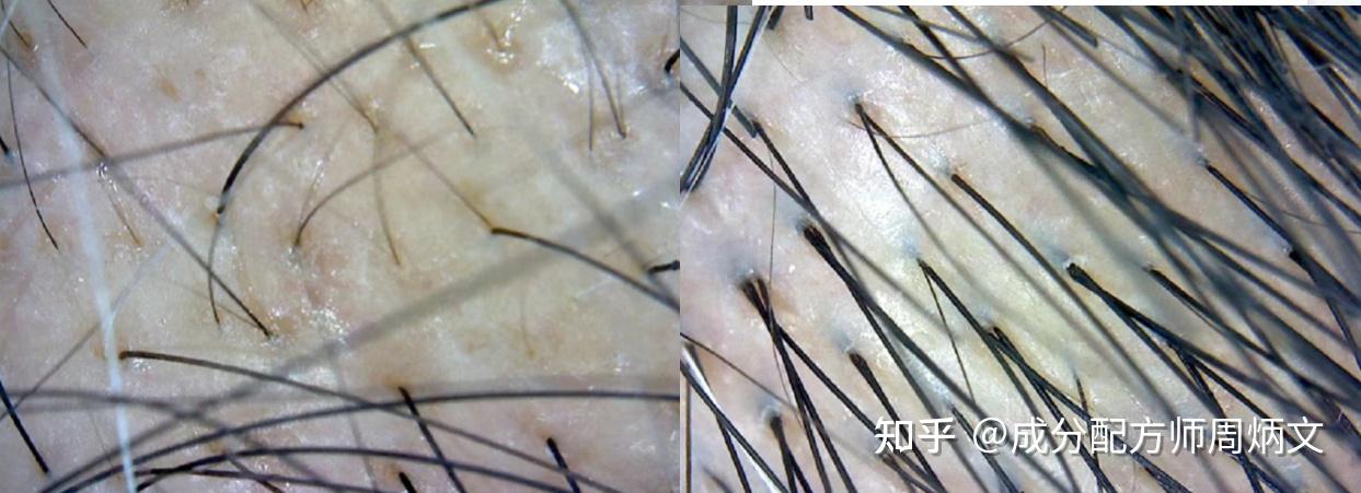 男生头发一直在掉，现在头顶发量稀疏，头皮特别明显，发际线也在后移！会很快秃吗？求问男生有什么好办法快速防脱吗？ 知乎 3179