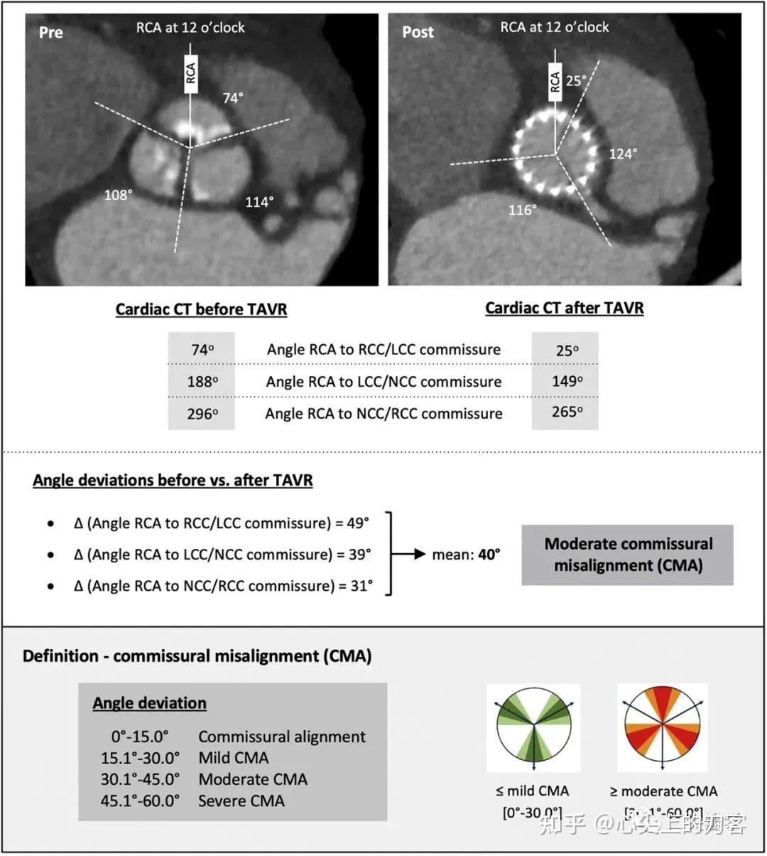 连合对齐（Commissural Alignment）：原理、定义、技术和结果（中） - 知乎