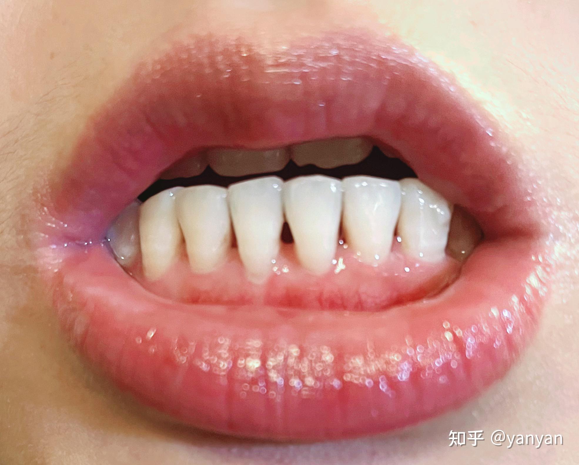 牙周膜龈手术+植骨（PAOO）记录 - 知乎