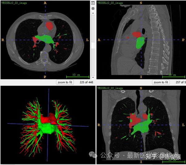 VESSEL2012——肺血管分割 - 知乎