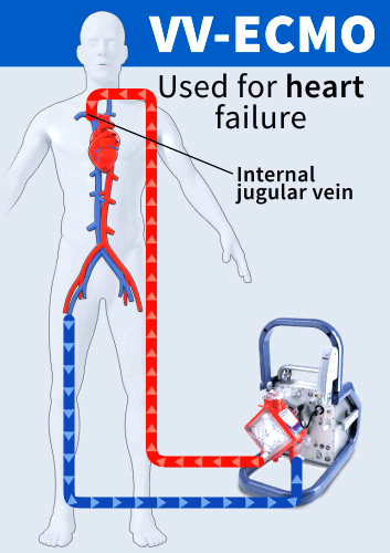 传说中的叶克膜（ECMO）是什么？ - 知乎