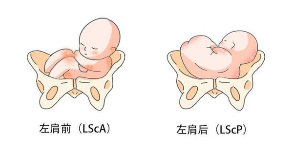 对胎位的描述LOA \ ROA \ LSA是？？？？ - 知乎