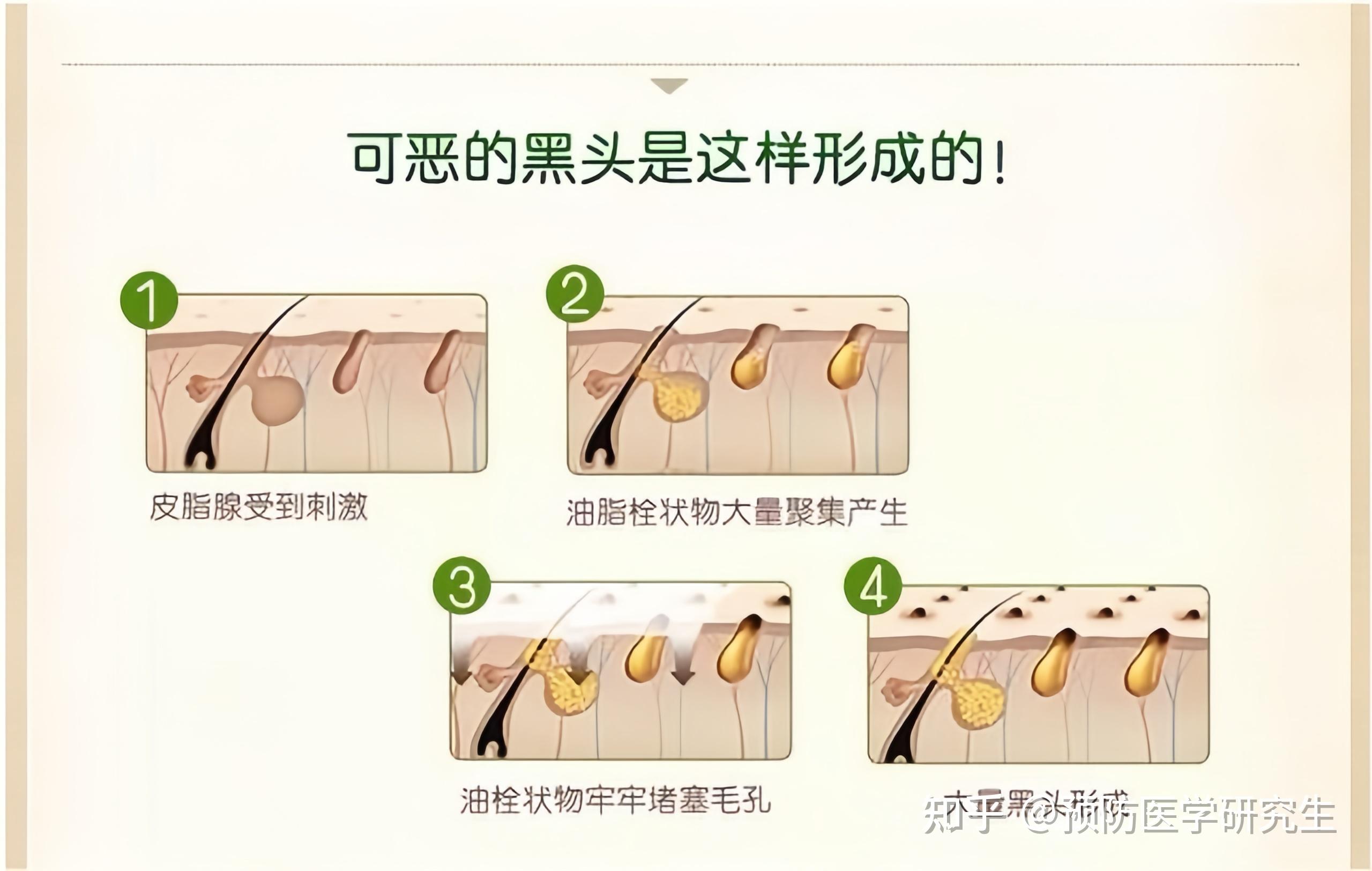 除了美容，祛黑头最有效的方法是什么？鼻子黑头怎么去除？ 知乎