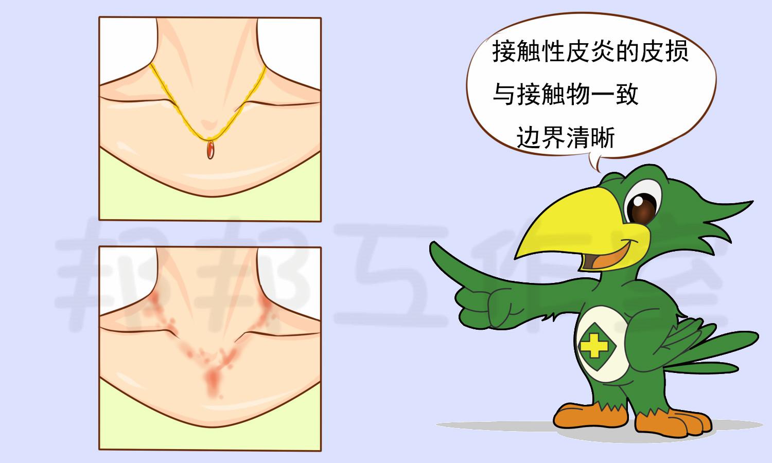 皮肤出现了急性过敏,应该怎么处理? 知乎