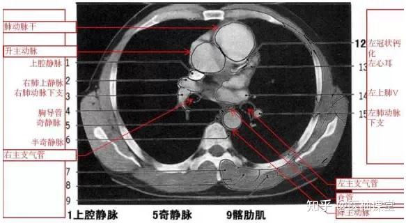 教你读懂胸部CT - 知乎