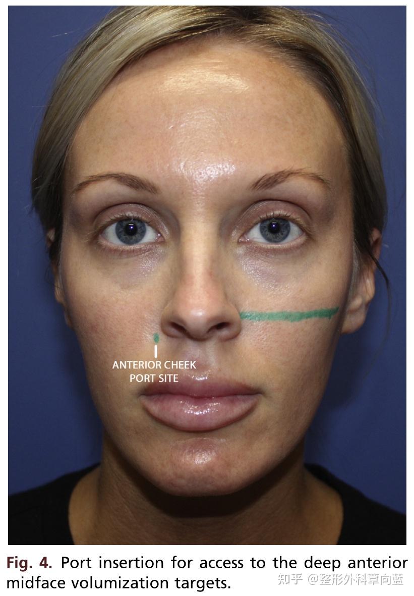 基于SMAS韧带的注射指导，即所谓的“True Lift”注射技术 - 知乎