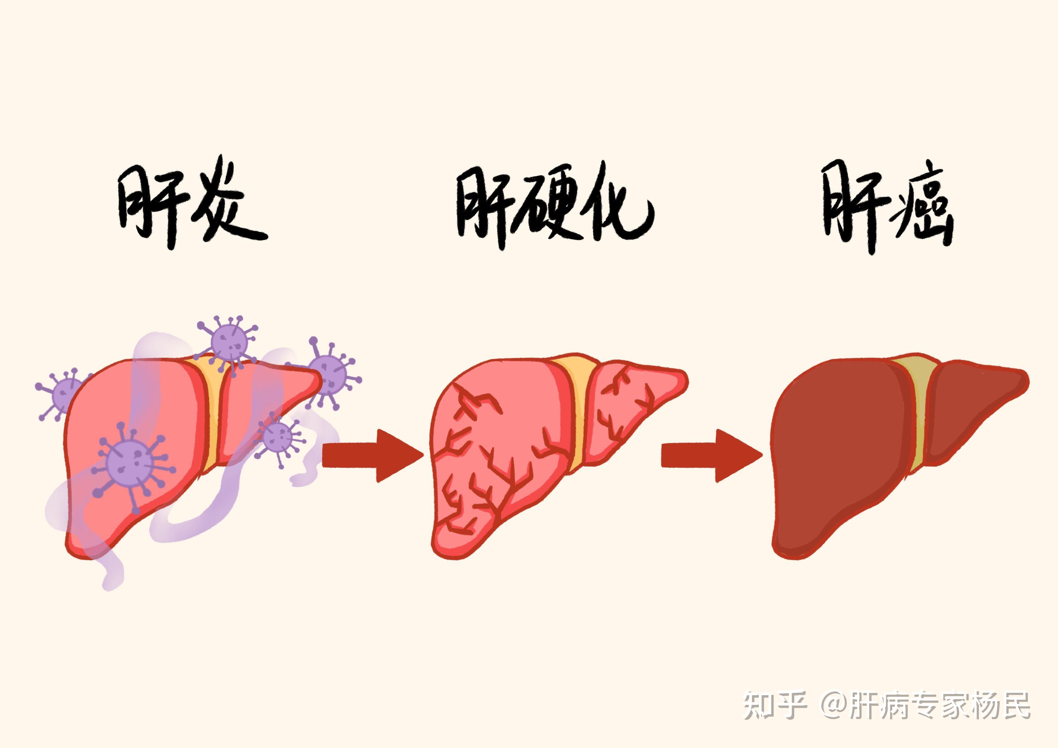 肝炎到肝癌只需4步,不想乙肝变成肝癌,做好这六 忌” 知乎