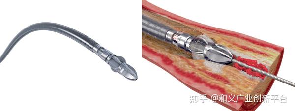 外周血管介入器械2——介绍3种外周动脉疾病介入治疗器械 - 知乎
