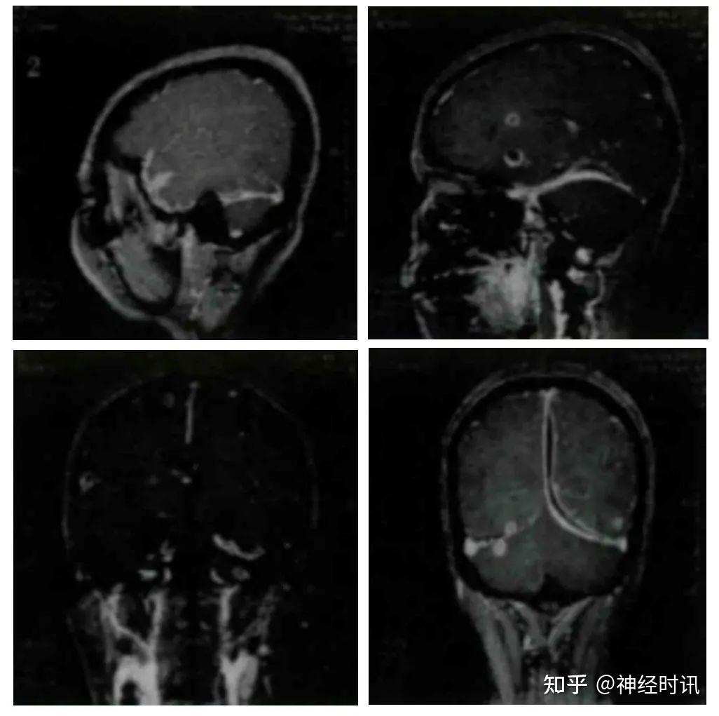 一文读懂化脓性脑膜炎的诊断与治疗 - 知乎