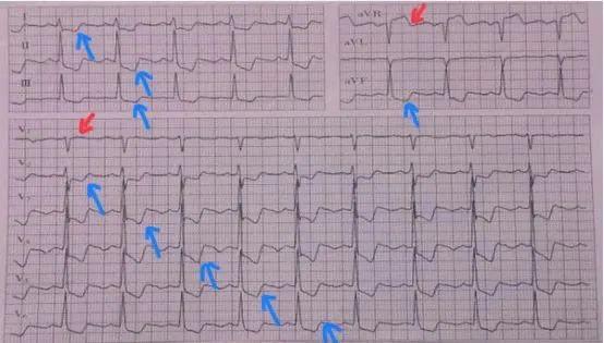 STEMI 等危心电图：“6+2”现象、Wellens征、de Winter 征 - 知乎