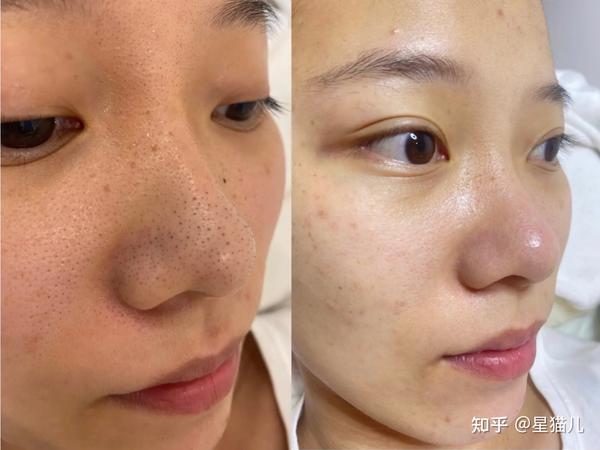 有没有那种一次见效，还不伤毛孔的去黑头产品？ 知乎