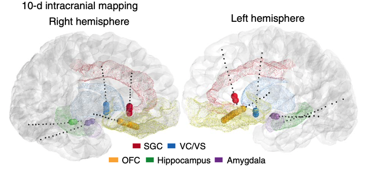 【THERAPY】Closed-loop neuromodulation in an individual with treatment ...