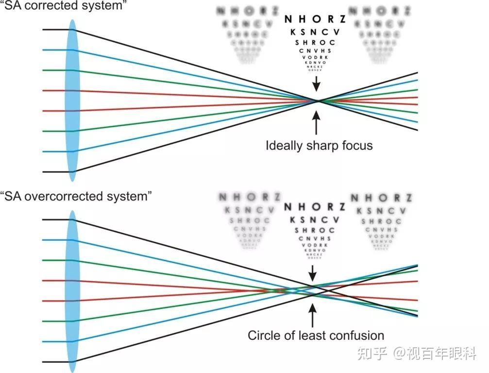 视百年眼科丨LBV融合视觉老视矫正手术，告别老花，开启清晰之旅 - 知乎