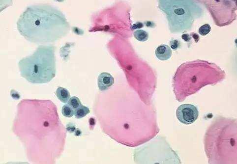 TCT报告单怎么看？ - 知乎