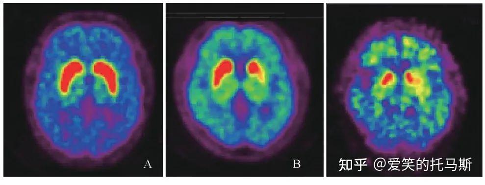 帕金森病(PD)是否需要做PETMR检查？ - 知乎