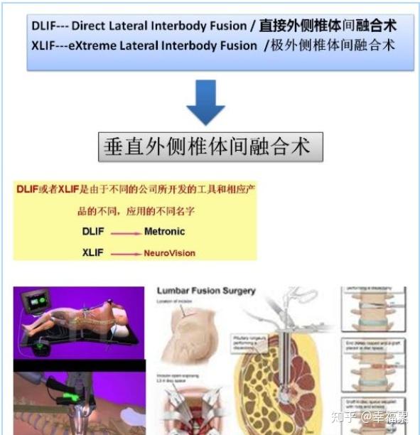 UBE 这些差别你知道吗？PLF PLIF TLIF DLIF XLIF 手术技术对比【医术苑】科普 - 知乎