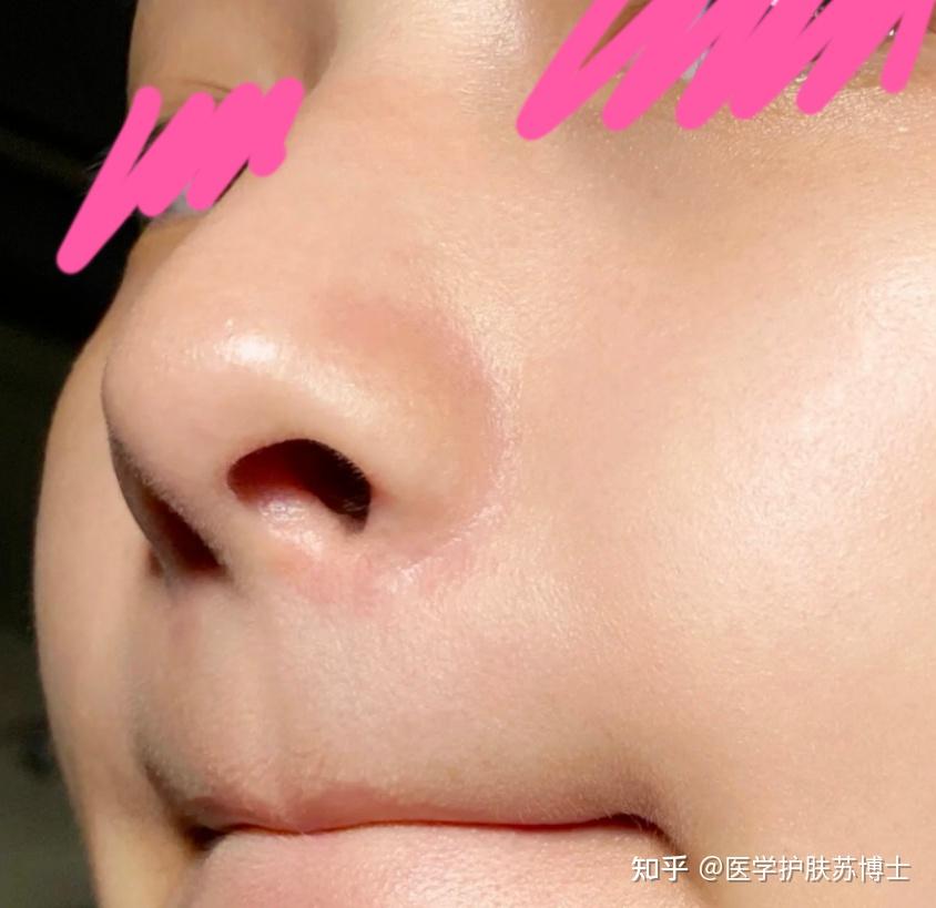 1个月去黑头【专业医学博士】教你最有效的去黑头方法,当你鼻子两侧被黑头爬满,毛孔也被撑大了,看完这篇彻底解救你的黑头鼻! 知乎