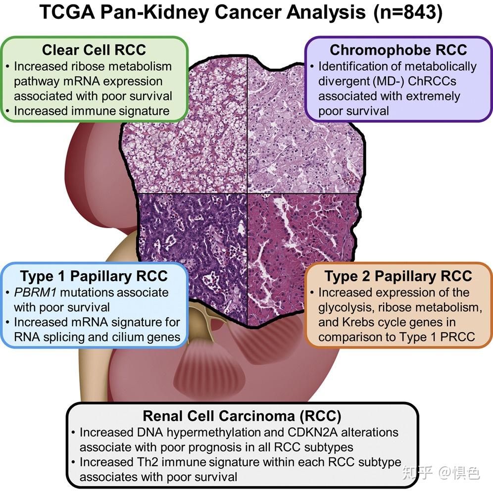 什么叫肾细胞癌？ - 知乎