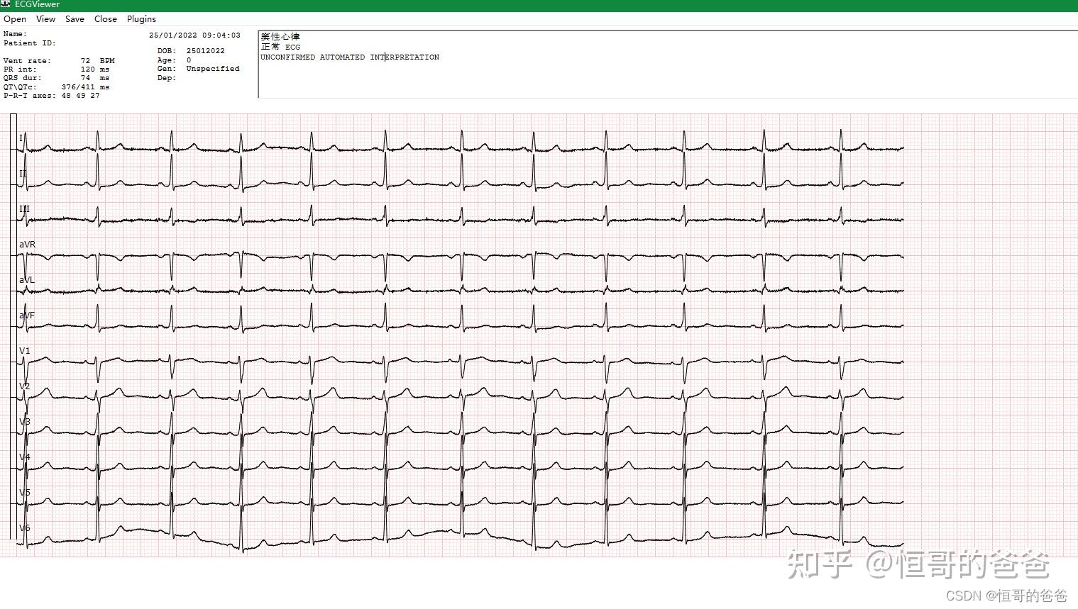 静态心电设备的数据采集（aECG） - 知乎