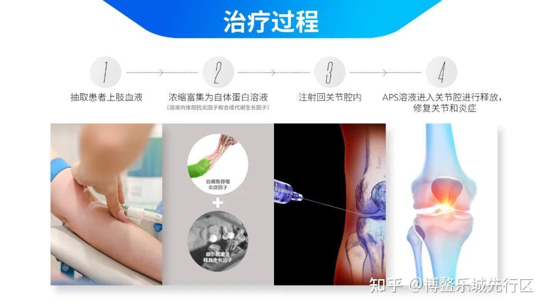 告别膝骨关节炎疼痛！一文了解乐城全球创新nSTRIDE®自体蛋白注射疗法 - 知乎