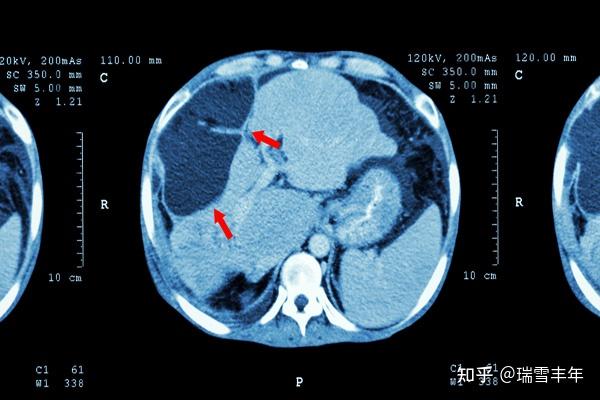 人参皂苷Rh2或Rg3单独服用效果好，还是配合aPPD、Rk2、Rh3等一起服用更好？ - 知乎