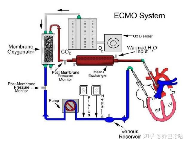 ECMO（人工肺） - 知乎