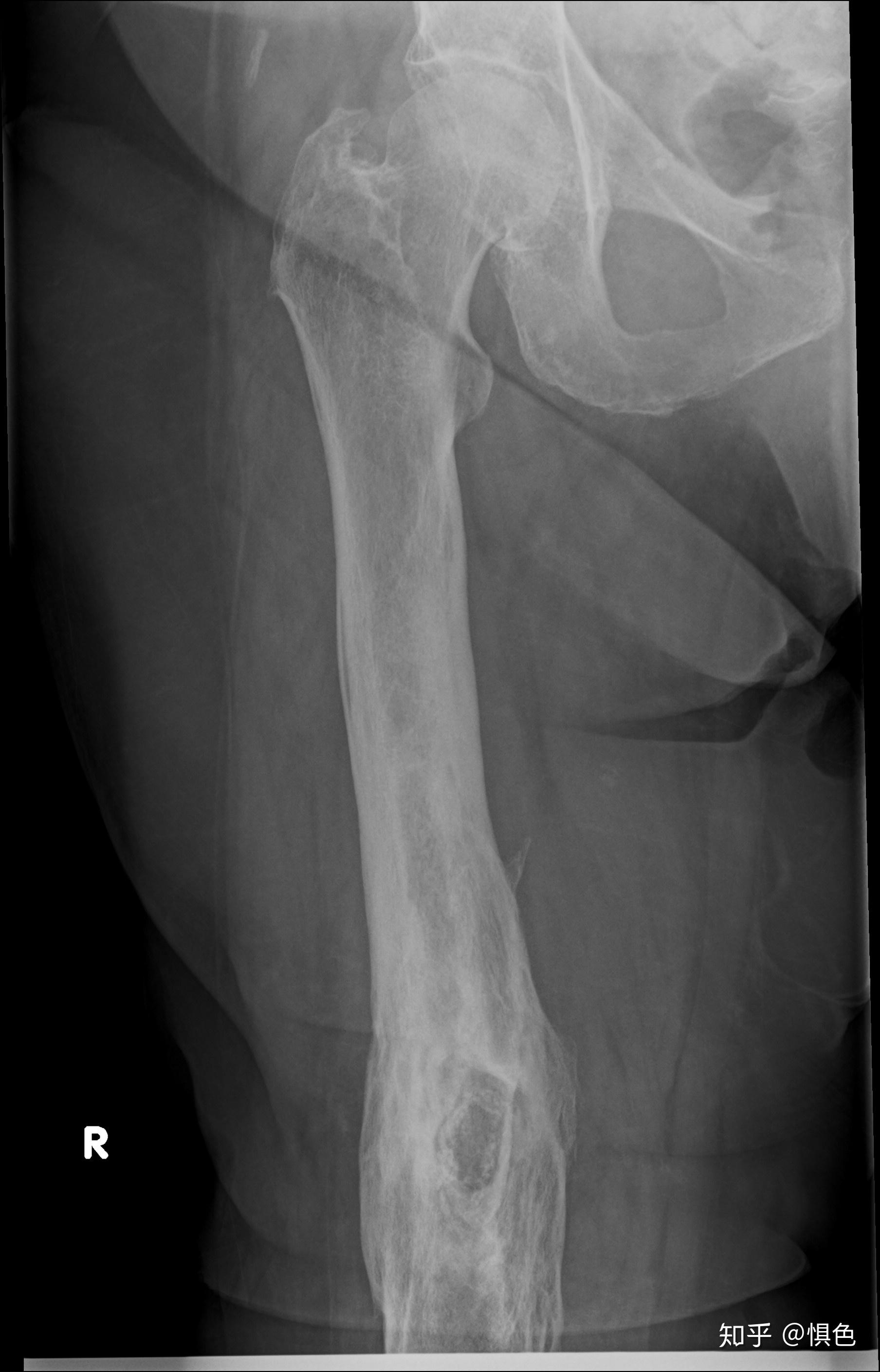 化脓性骨髓炎 Purulent Osteomyelitis - 知乎