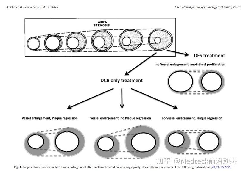 药物球囊之父Bruno Scheller：他如何改写血管介入治疗的未来？ - 知乎