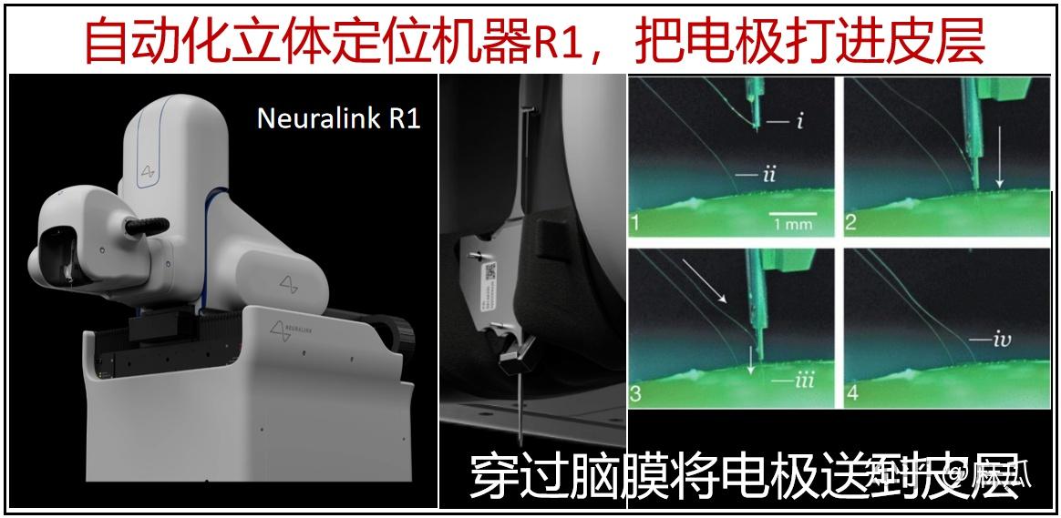 马斯克称 Neuralink 完成首例人类脑机接口设备植入，志愿者目前恢复良好，如何评价这一技术？ - 知乎