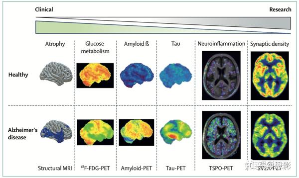 淀粉样蛋白PET和18F-FDG-PET对阿尔茨海默病和其他痴呆的诊断研究 - 知乎