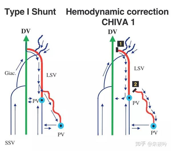 CHIVA治疗下肢静脉曲张：优势与结果 - 知乎
