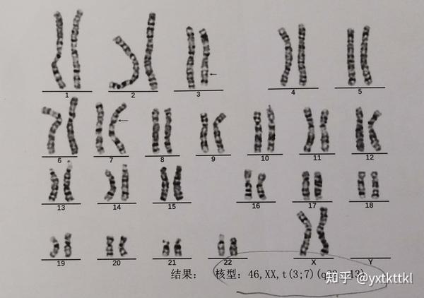 遗传咨询之平衡易位案例 - 知乎