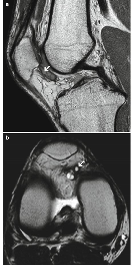膝关节Hoffa’s 综合症磁共振表现 - 知乎