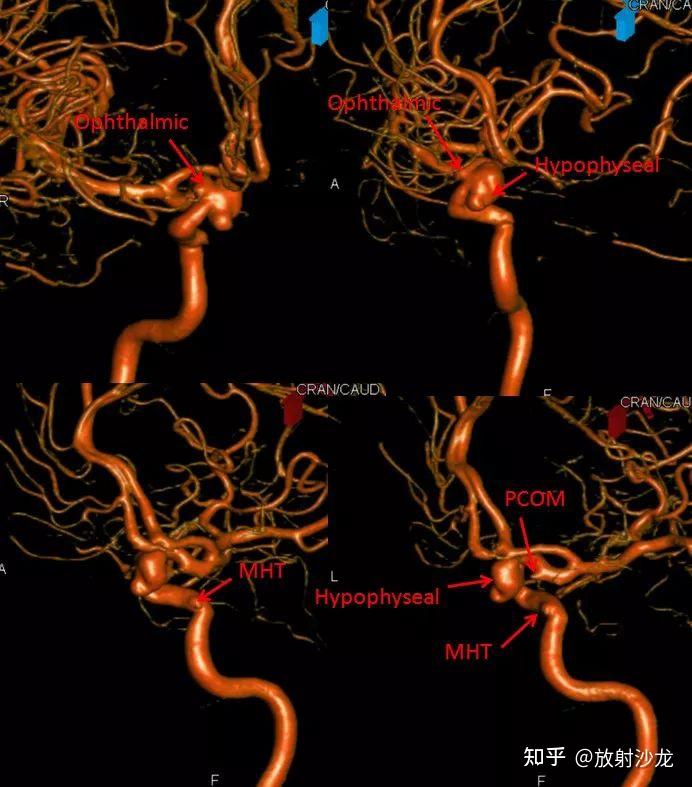 颈内动脉走形：概述及颈段 - 知乎