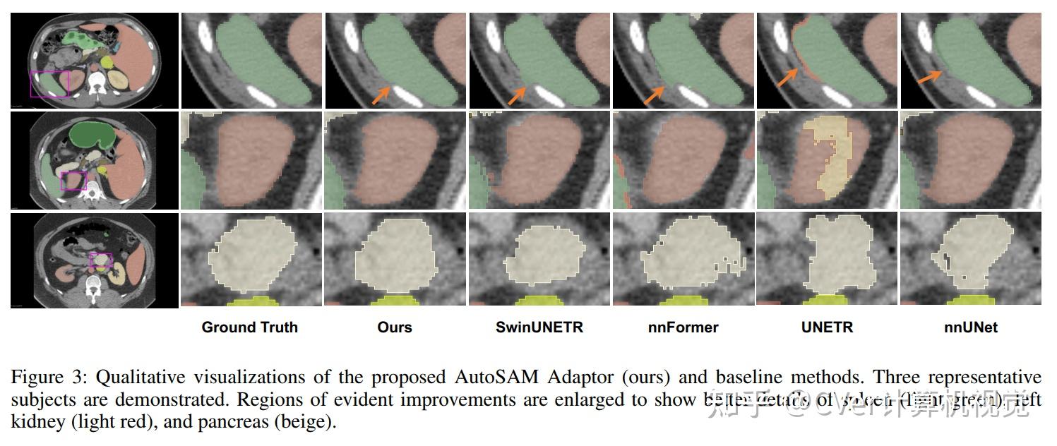 首个！AutoSAM Adapter：自动提示SAM以实现强大的3D医学图像分割 - 知乎
