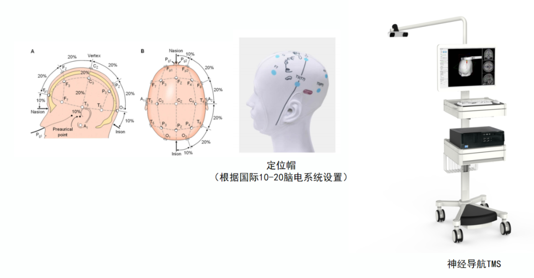 2025年rTMS治疗抑郁症的临床医师指南（下）:患者评估与治疗操作、TMS的不良反应及潜在风险、其他临床问题 - 知乎