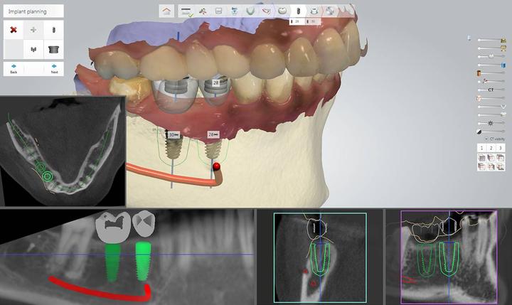 什么是口腔CBCT，种牙为什么要拍CBCT片？ - 知乎