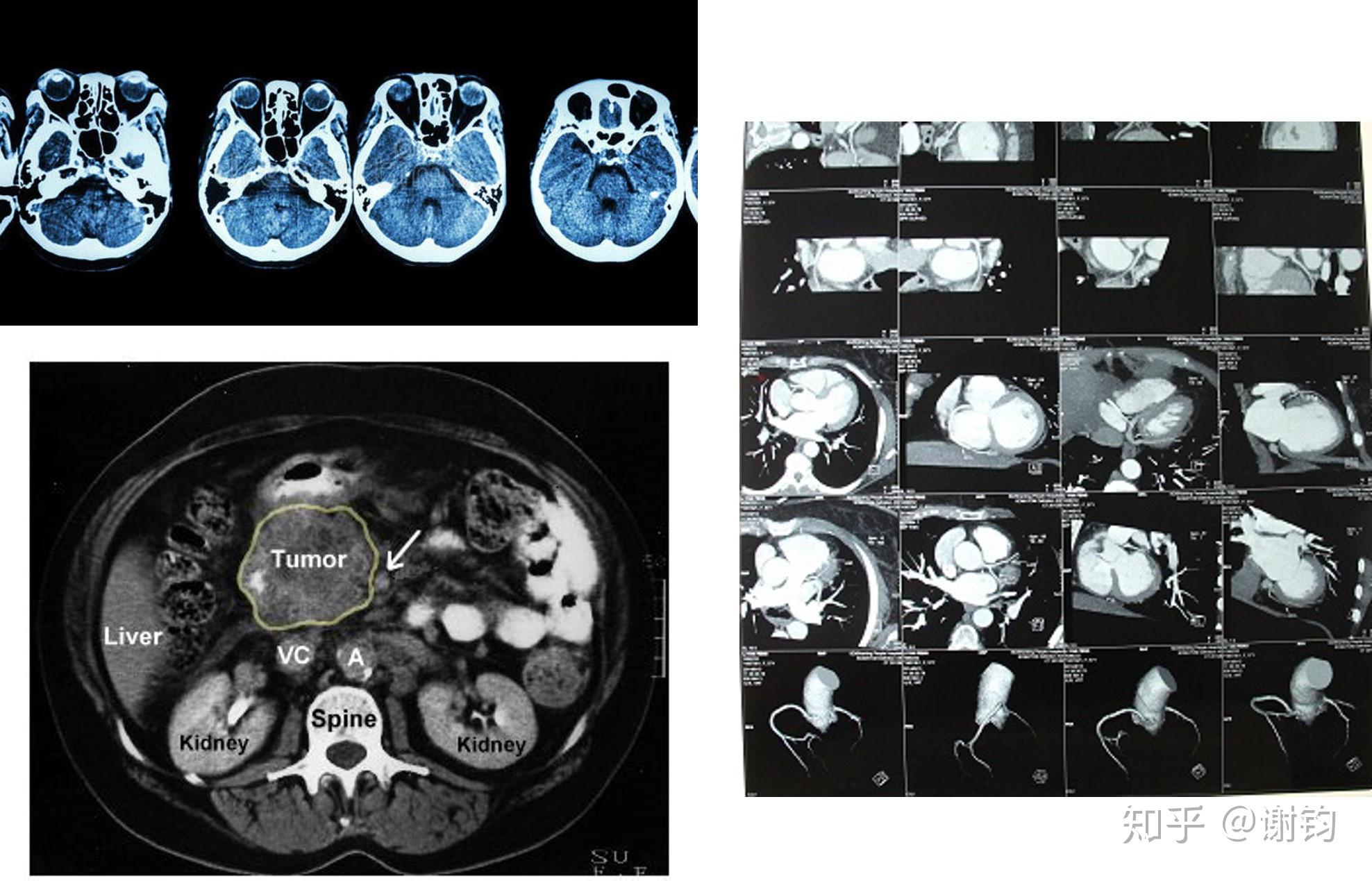 现代医学成像（3）——CT（基本原理与图像重建） - 知乎