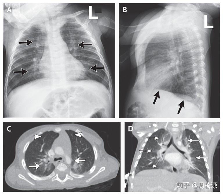Nejm 2011 Case 37 - 知乎