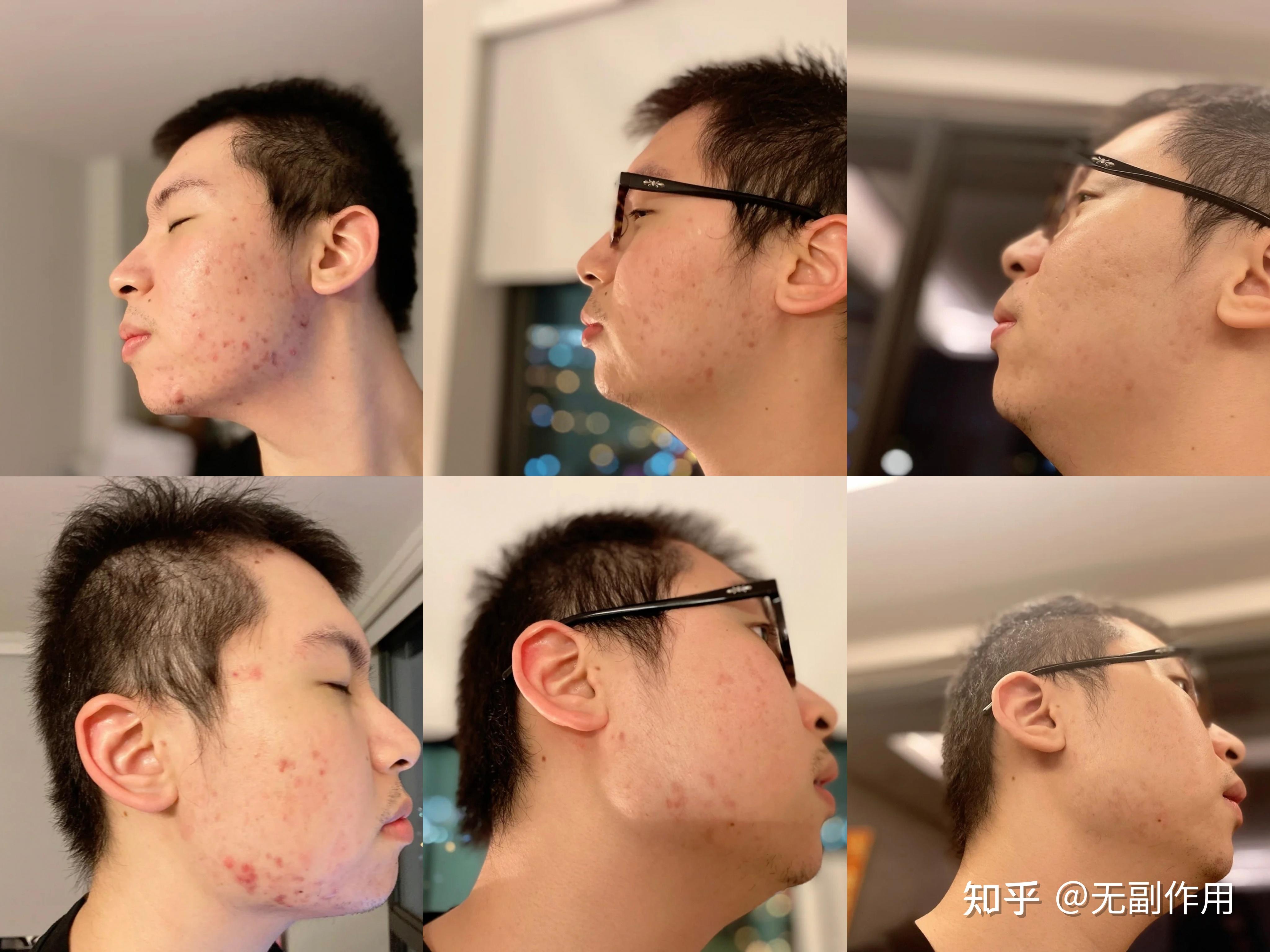 你们脸上的痘痘是用什么消掉的？ 知乎
